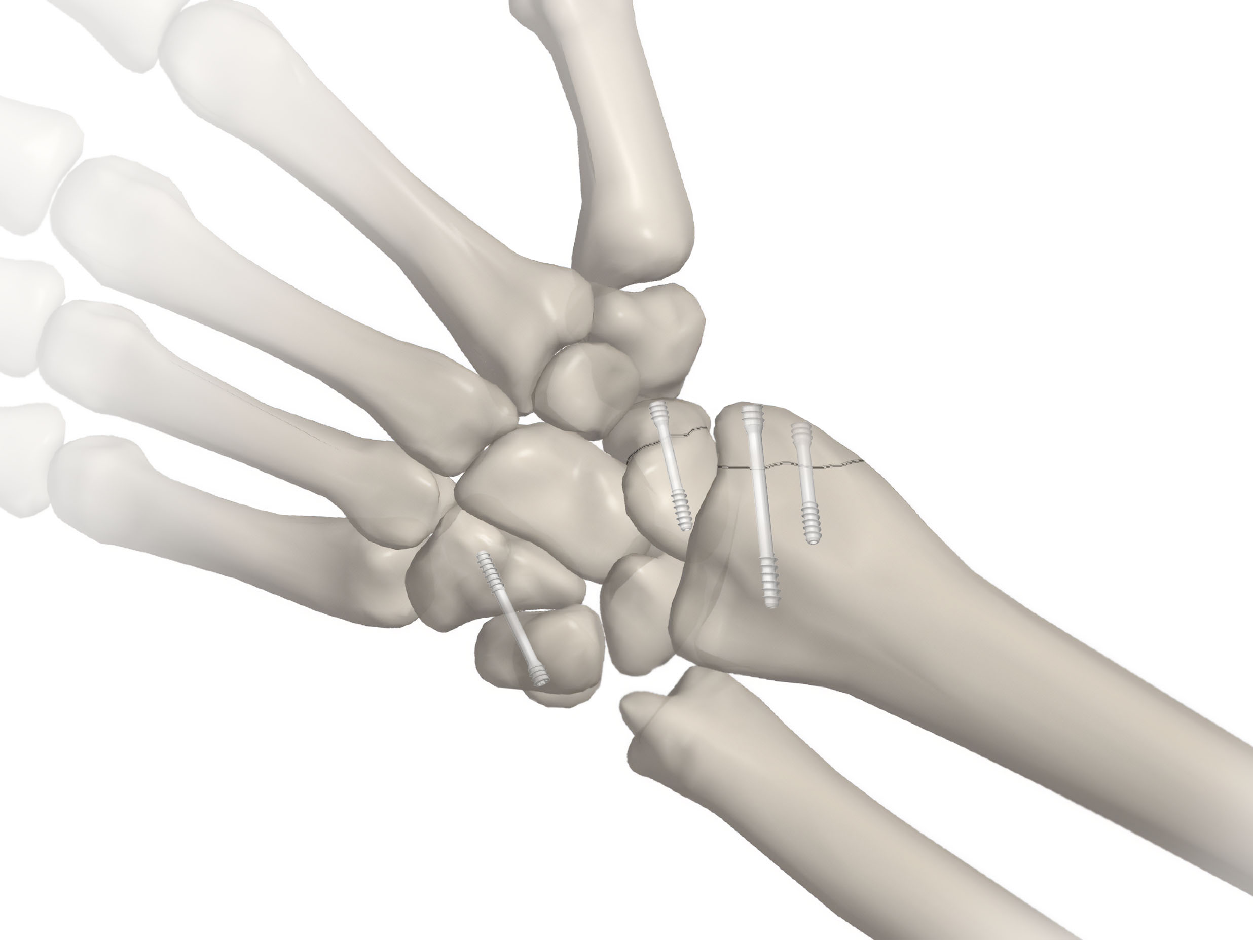 Inion - Products - CompressOn™ Headless Compression Screw